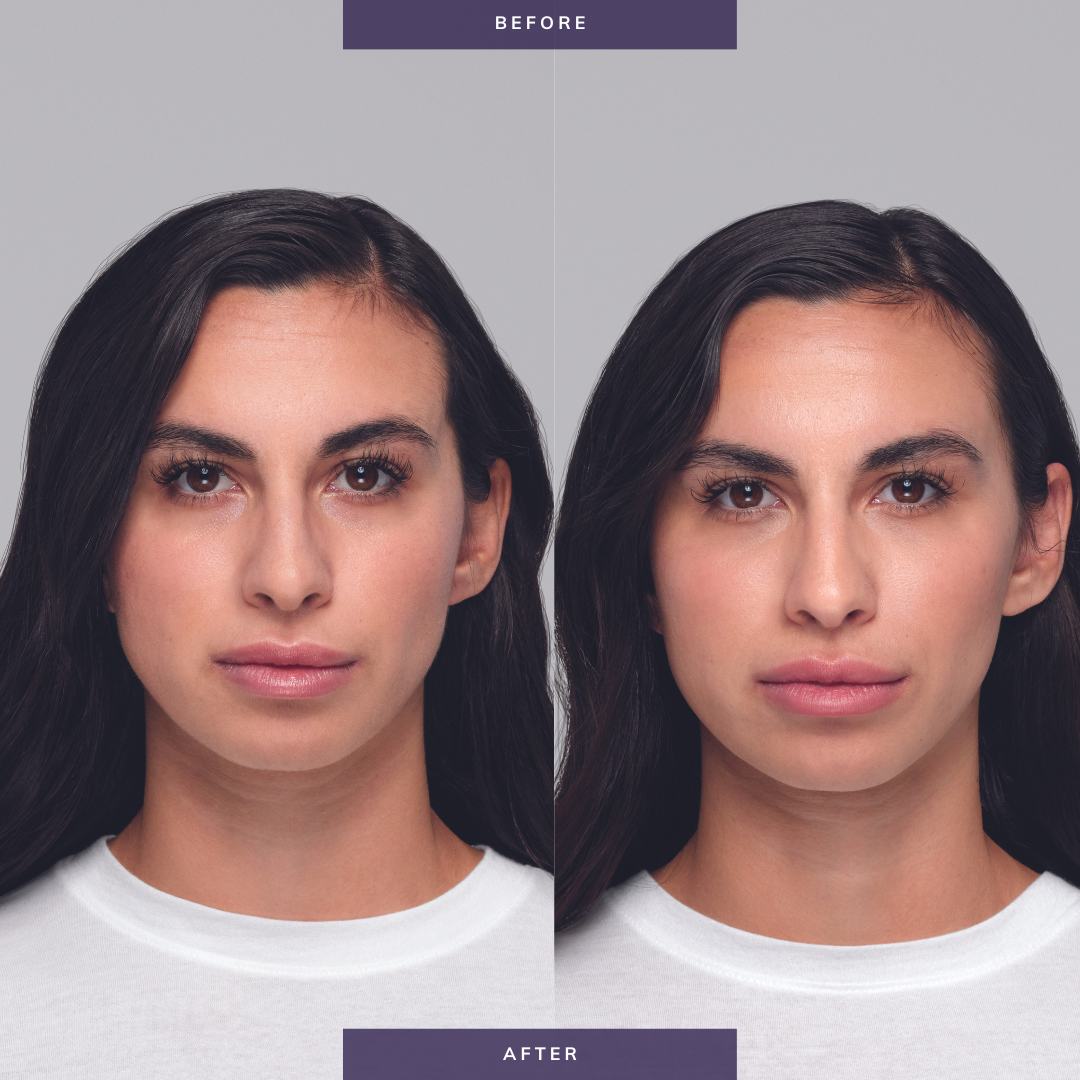 Restylane® Lyft (Service) – Sōna Dermatology
